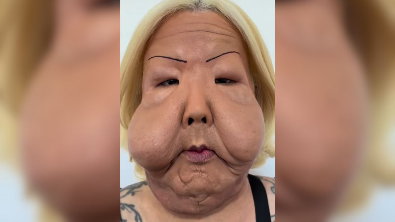 Quem é Juju do Pix, influenciadora que teve rosto deformado após cirurgia